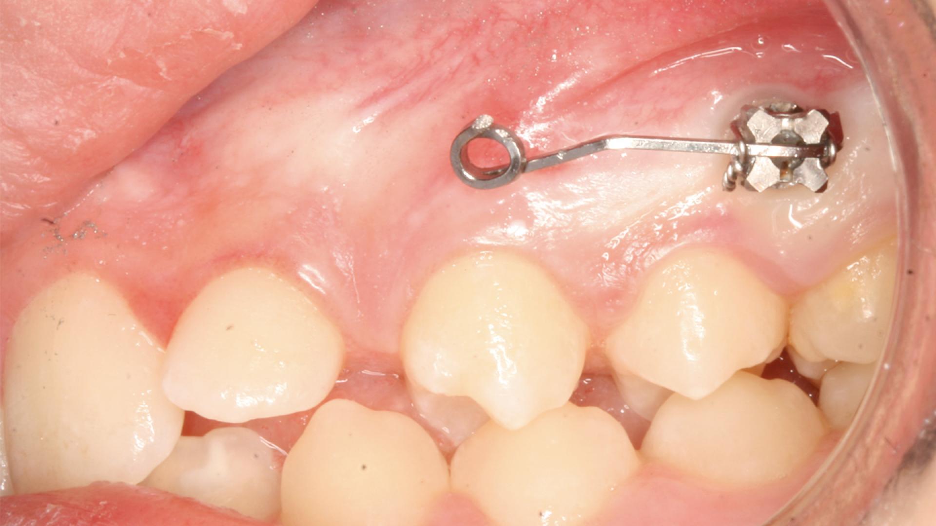 Microimplantes en ortodoncia: nuevas estrategias de tratamiento ...