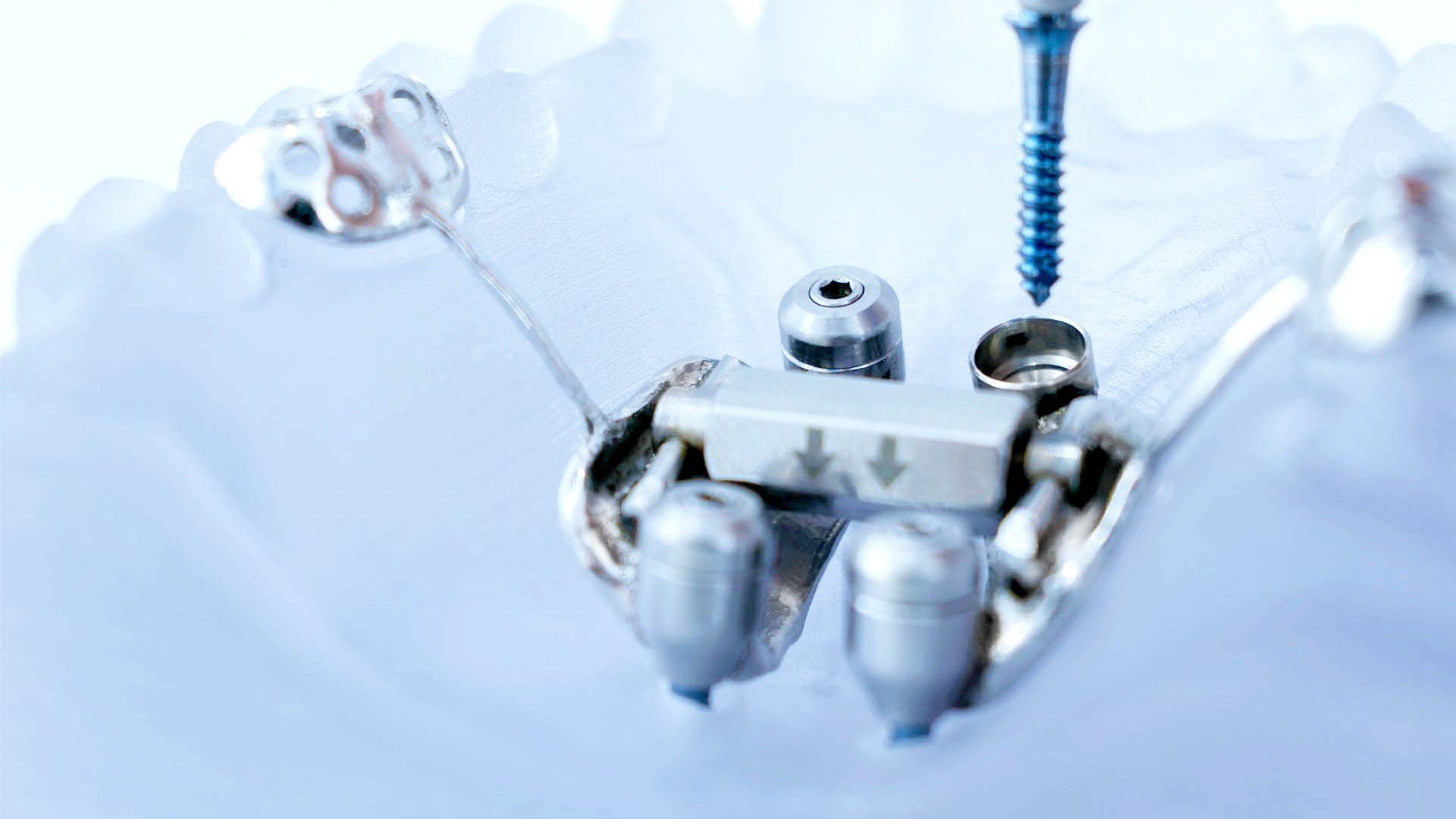 Cirugía guiada para la colocación de microtornillos auxiliares en los ...